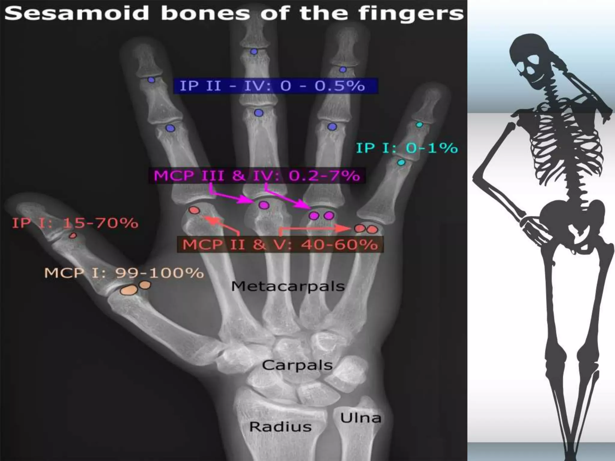 SESAMOID BONES | PPT | Death, Injury, or Military Conflict | Sensitive ...