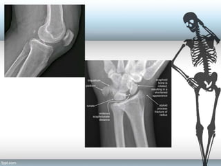 SESAMOID BONES | PPT