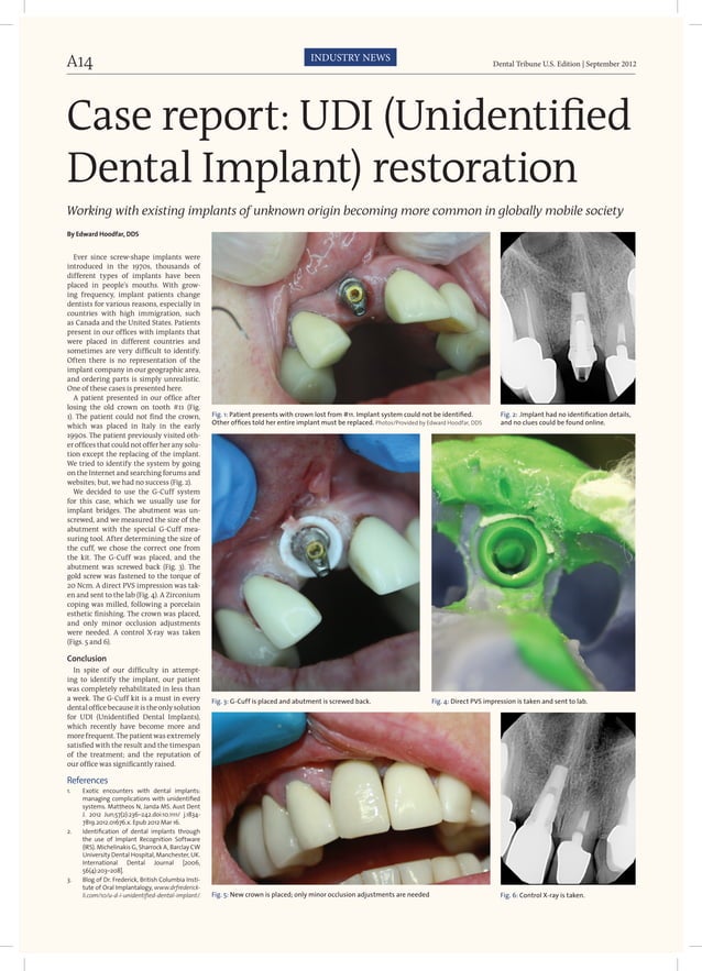 G-Cuff™ implant impression and unknown implants - October 2012 | PDF | Dental Health | Diseases ...