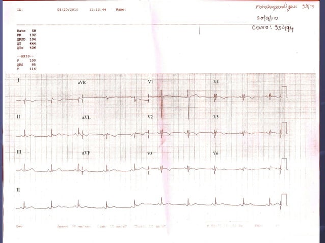 ECG: Dextrocardia | PPT | Heart and Cardiovascular Diseases | Diseases ...