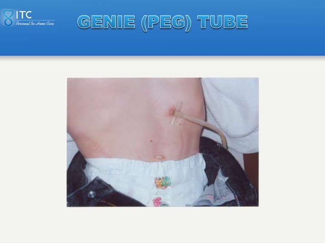 G tube training | PPTX