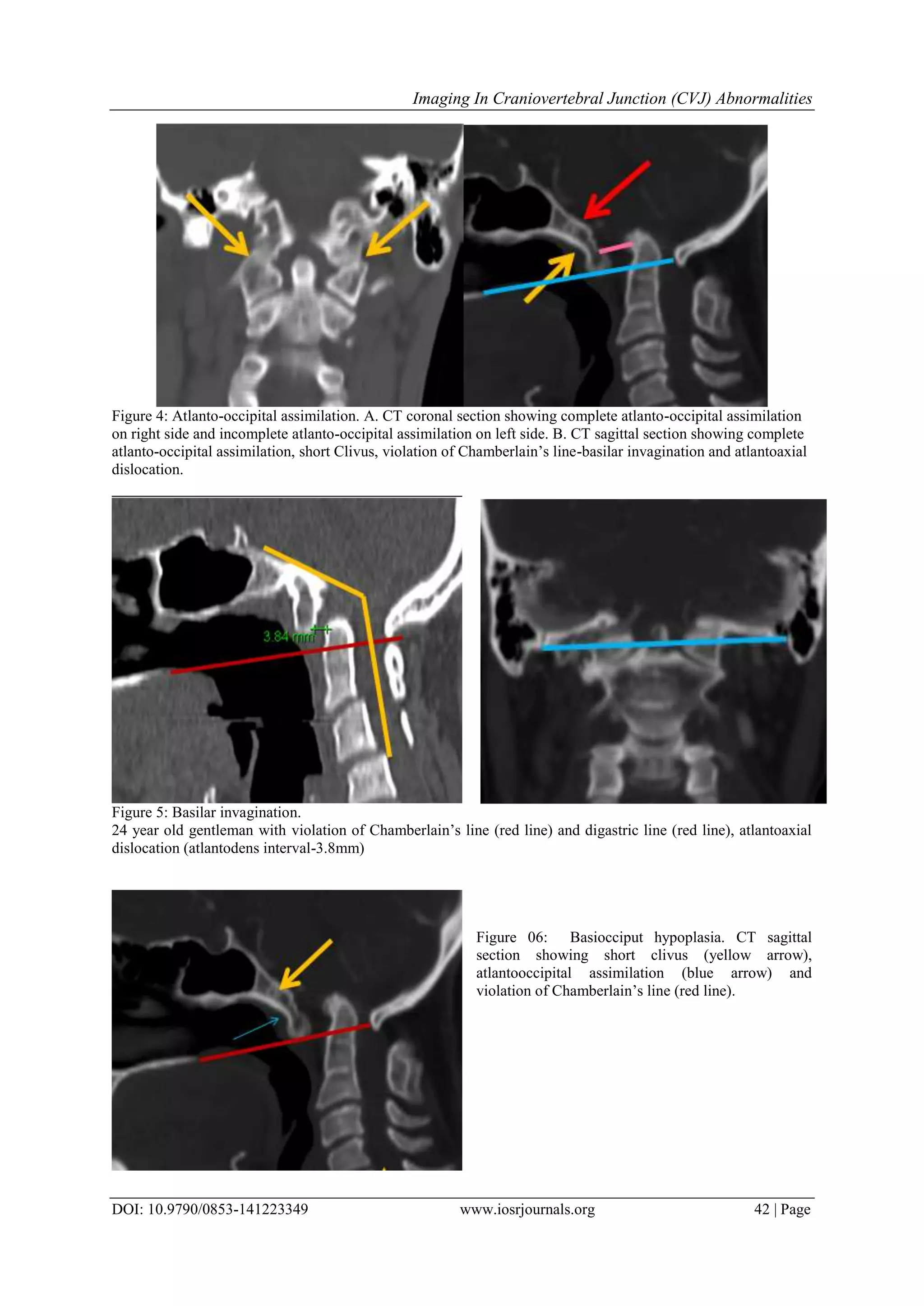 Imaging In Craniovertebral Junction (CVJ) Abnormalities | PDF