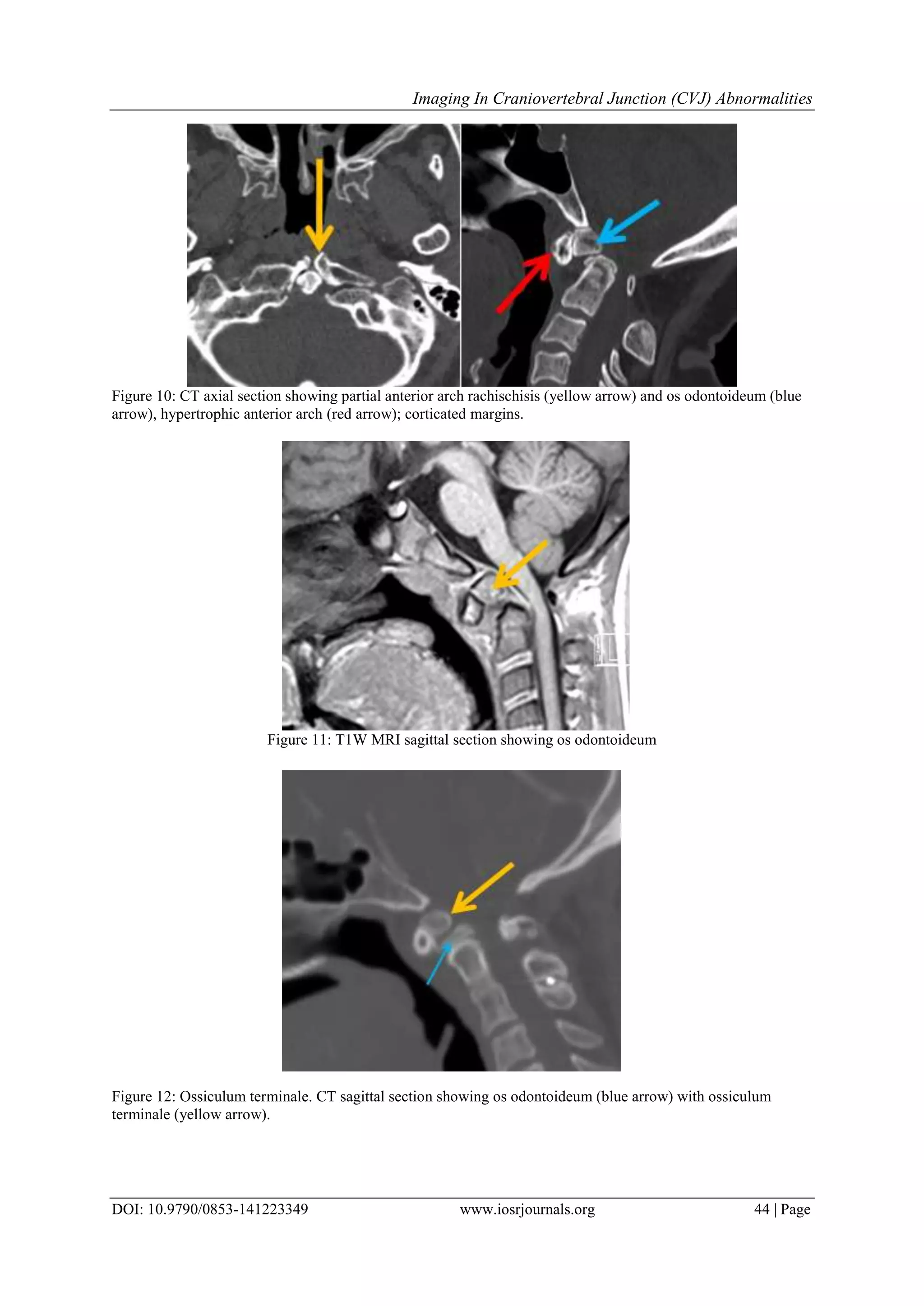 Imaging In Craniovertebral Junction (CVJ) Abnormalities | PDF