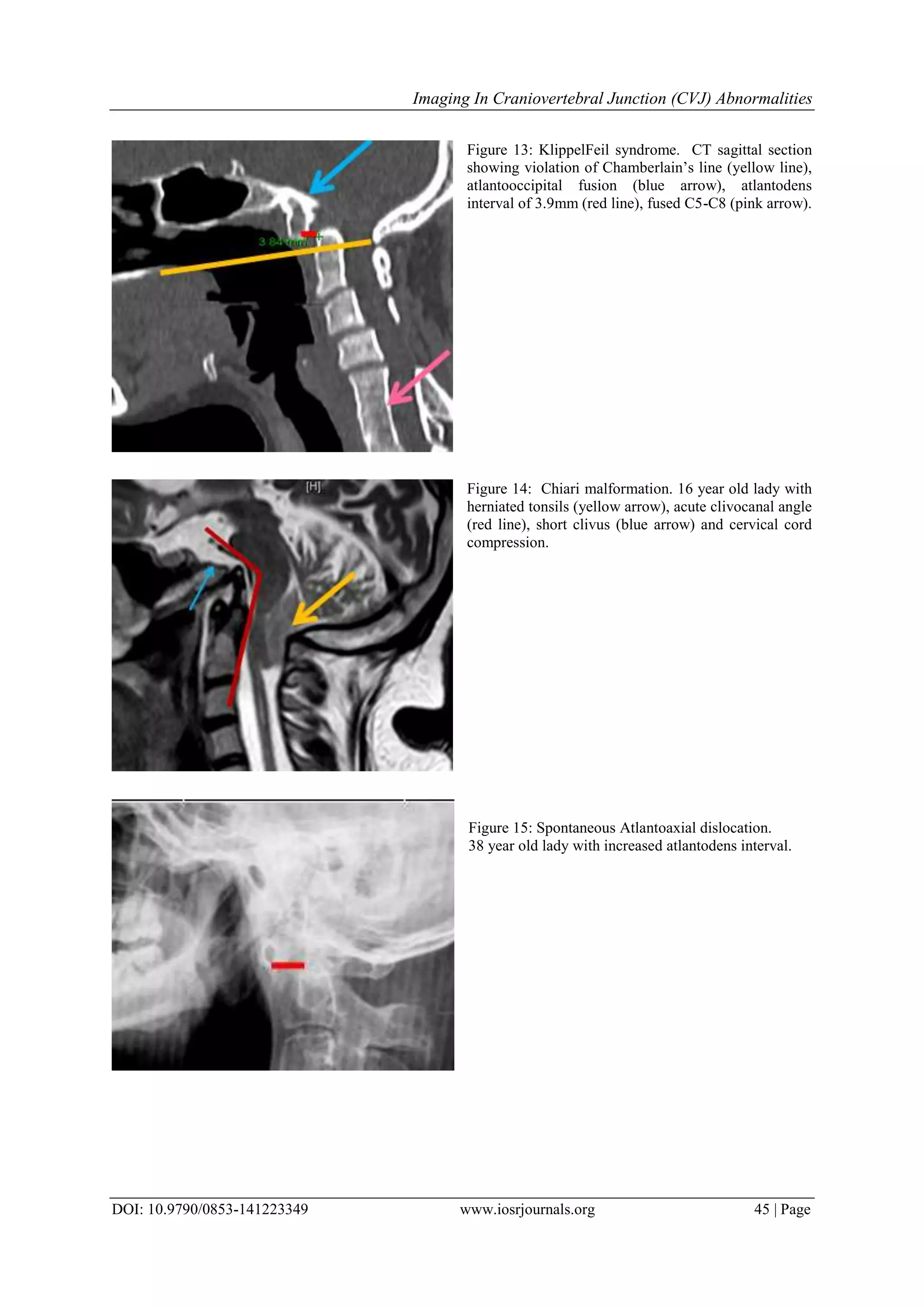 Imaging In Craniovertebral Junction (CVJ) Abnormalities | PDF