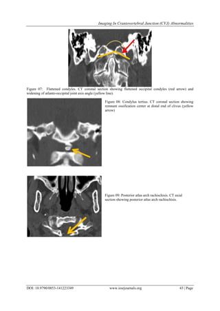 Imaging In Craniovertebral Junction (CVJ) Abnormalities | PDF