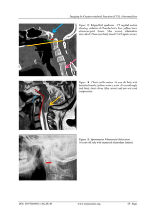 Imaging In Craniovertebral Junction (CVJ) Abnormalities | PDF