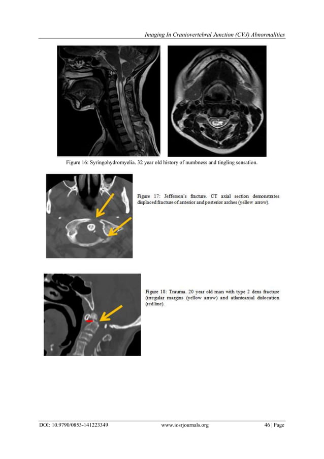 Imaging In Craniovertebral Junction (CVJ) Abnormalities | PDF