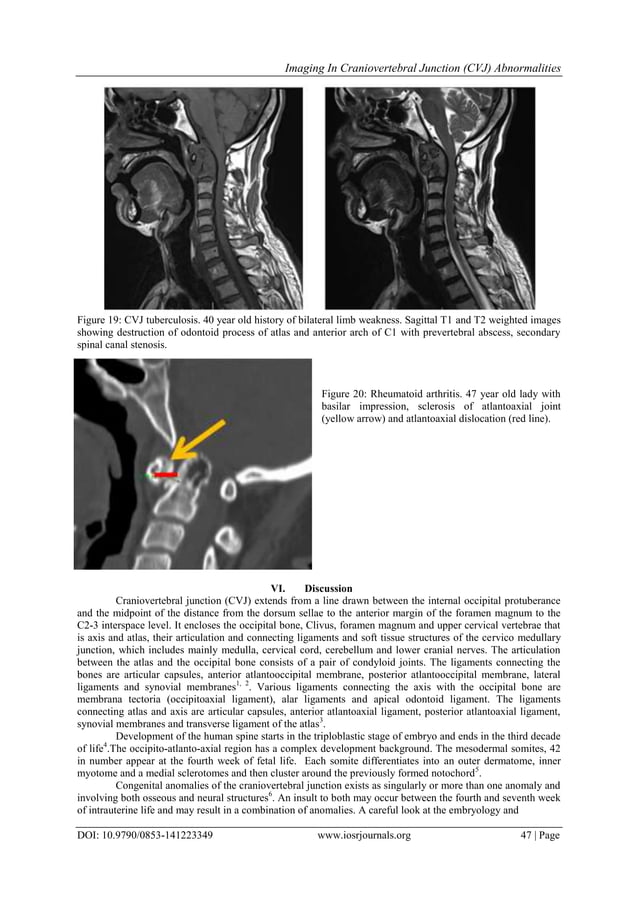Imaging In Craniovertebral Junction (CVJ) Abnormalities | PDF