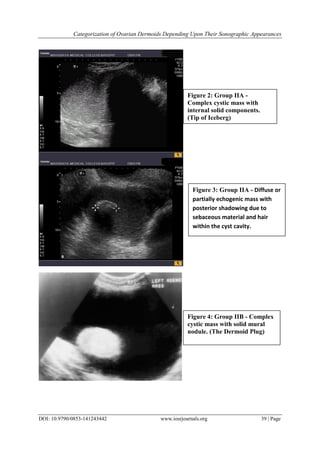 Categorization of Ovarian Dermoids Depending Upon Their Sonographic ...