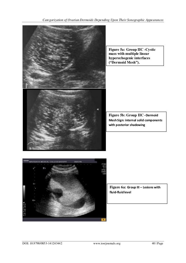 Categorization Of Ovarian Dermoids Depending Upon Their Sonographic A…