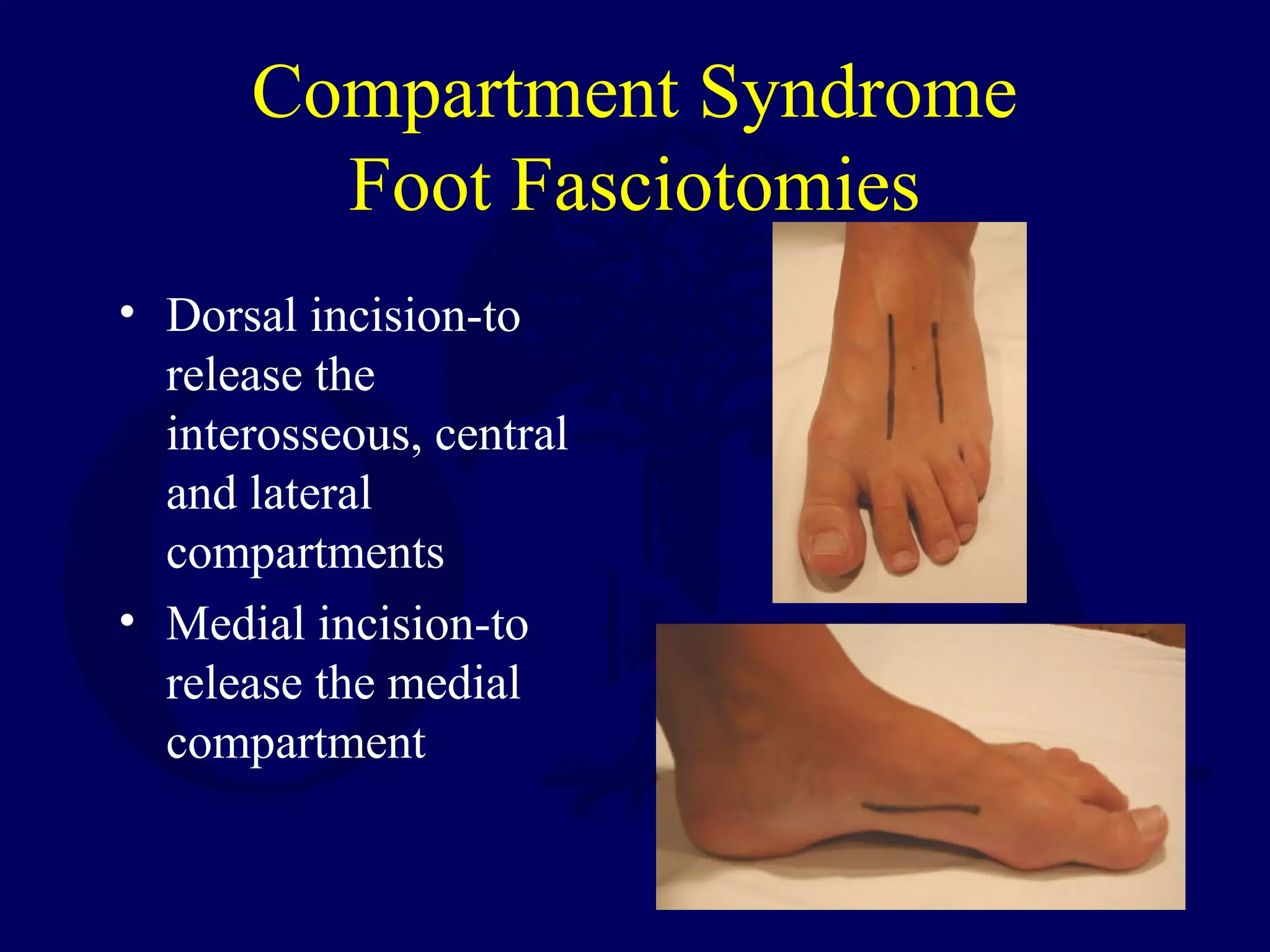 G04 compartment syndrome | PPT