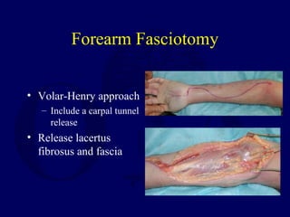 G04 compartment syndrome | PPT