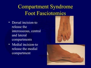G04 compartment syndrome | PPT