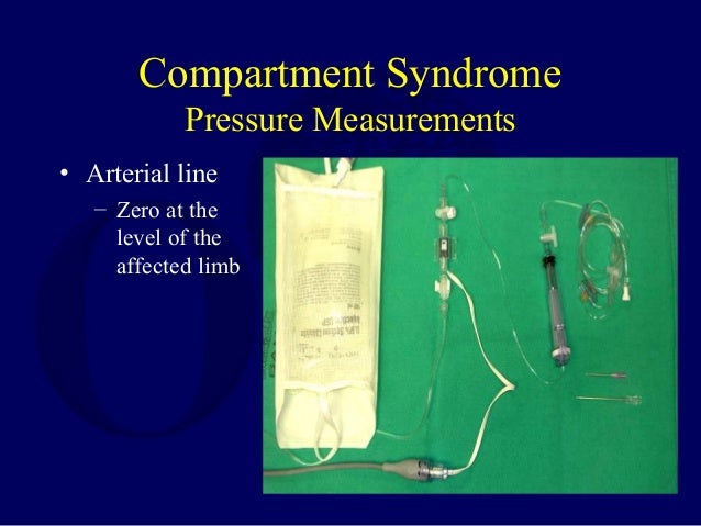 G04 compartment syndrome