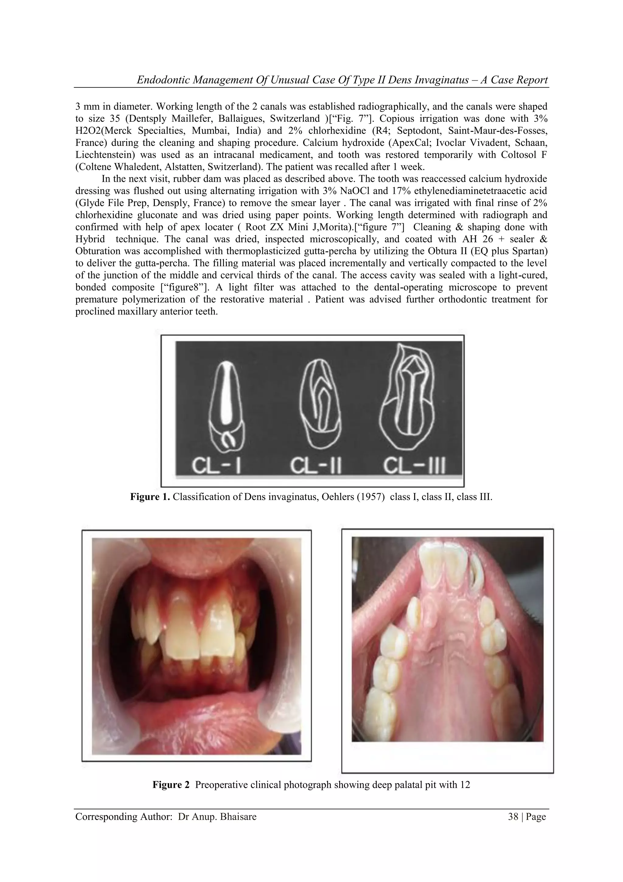 Endodontic Management of Unusual Case of Type II Dens Invaginatus – A ...