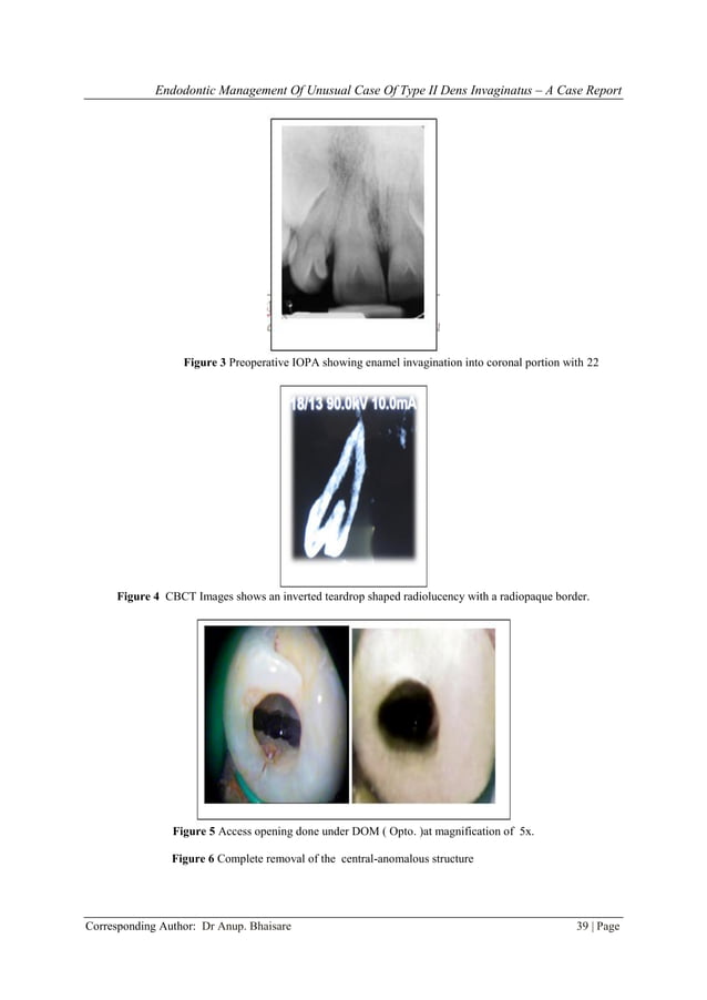 Endodontic Management of Unusual Case of Type II Dens Invaginatus – A Case Report | PDF