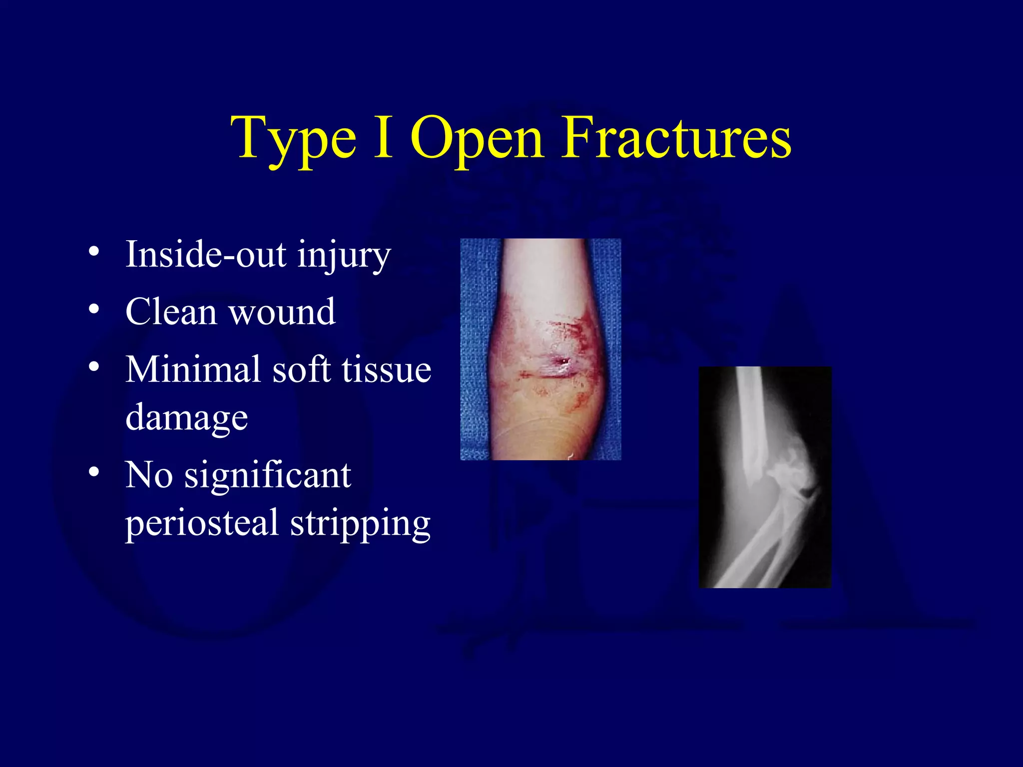G06 fracture classification | PPT