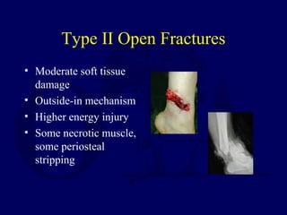 G06 fracture classification | PPT