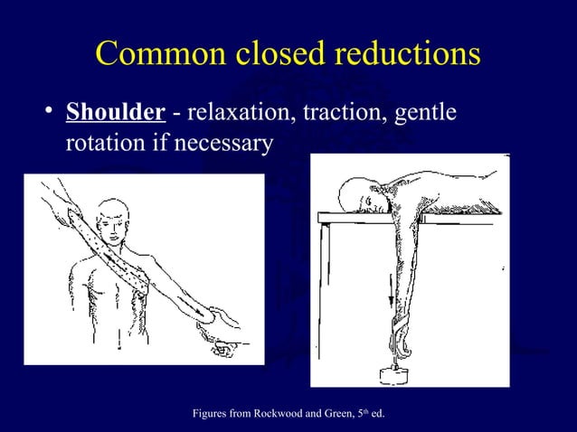 G09 crc, traction, casts | PPT