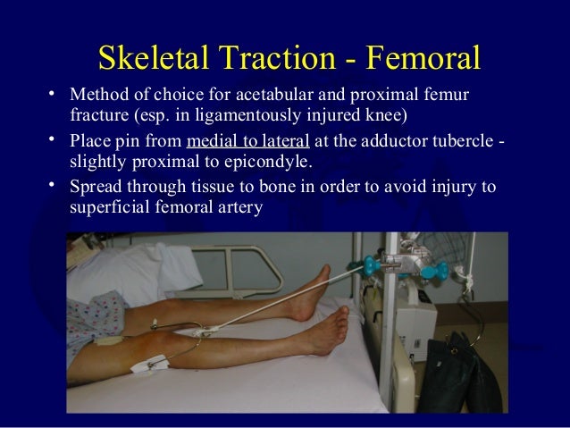 G09 crc, traction, casts