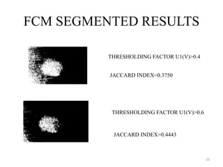 Segmentation Results through FCM clustering with MATLAB program | PPTX