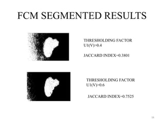 Segmentation Results through FCM clustering with MATLAB program | PPTX