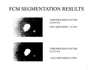 Segmentation Results through FCM clustering with MATLAB program | PPTX