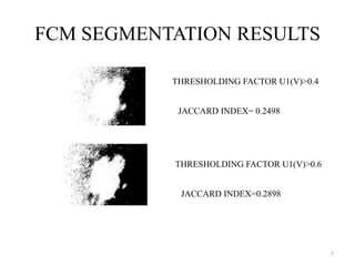 Segmentation Results through FCM clustering with MATLAB program | PPTX