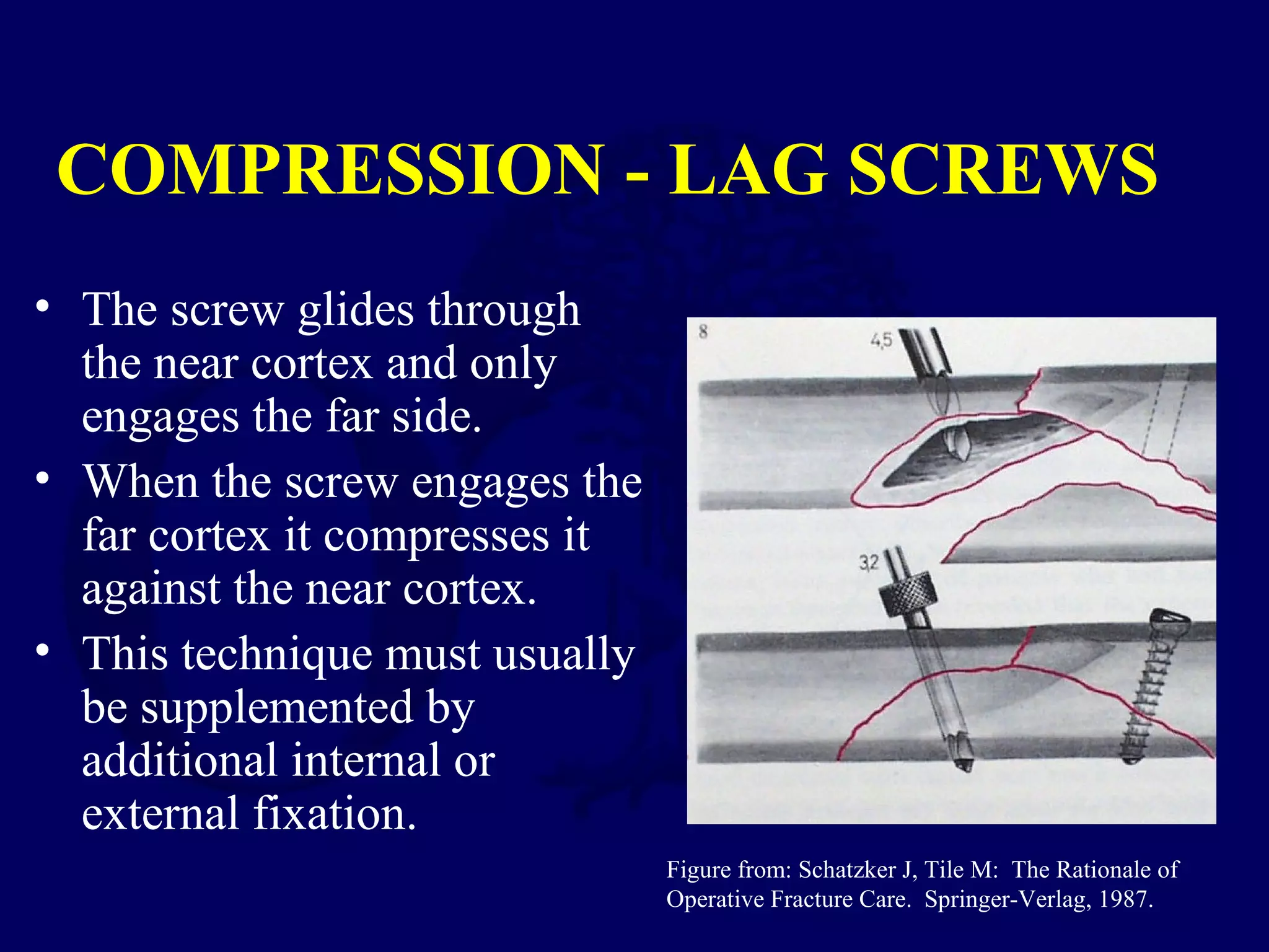 G10 internal fix principles | PPT | First Aid | Injuries