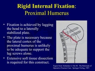G10 internal fix principles | PPT