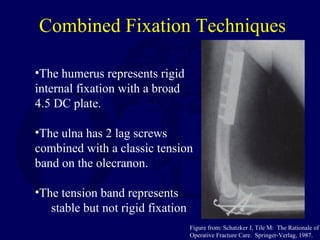 G10 internal fix principles | PPT | First Aid | Injuries