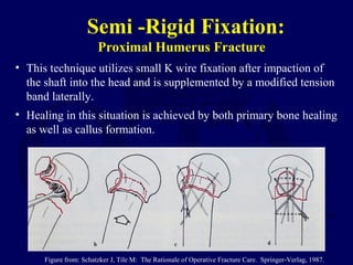 G10 internal fix principles | PPT | First Aid | Injuries