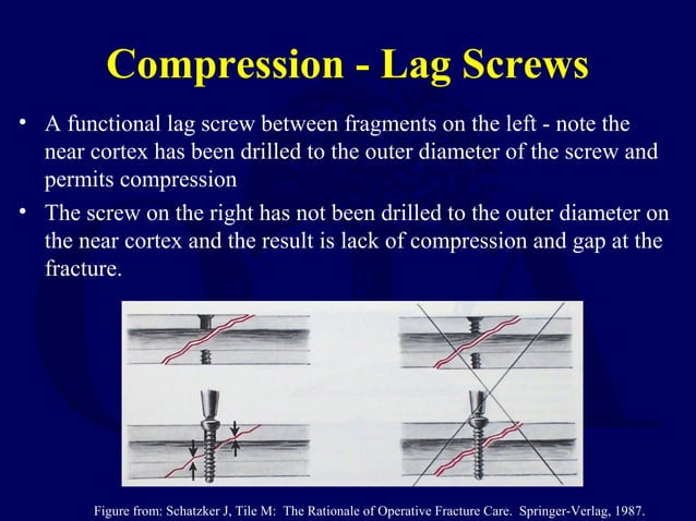 G10 internal fix principles | PPT | First Aid | Injuries