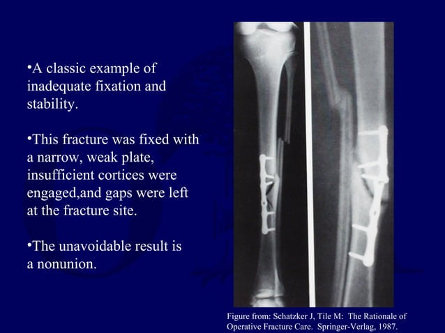 G10 internal fix principles | PPT | First Aid | Injuries