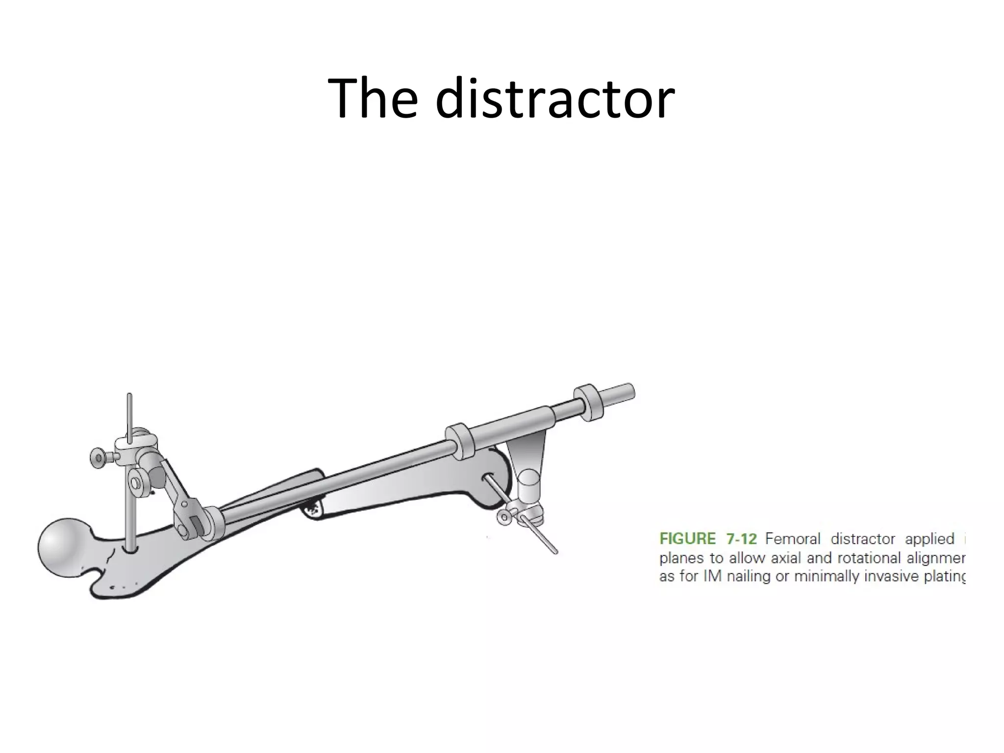 principles of internal fixation | PPT
