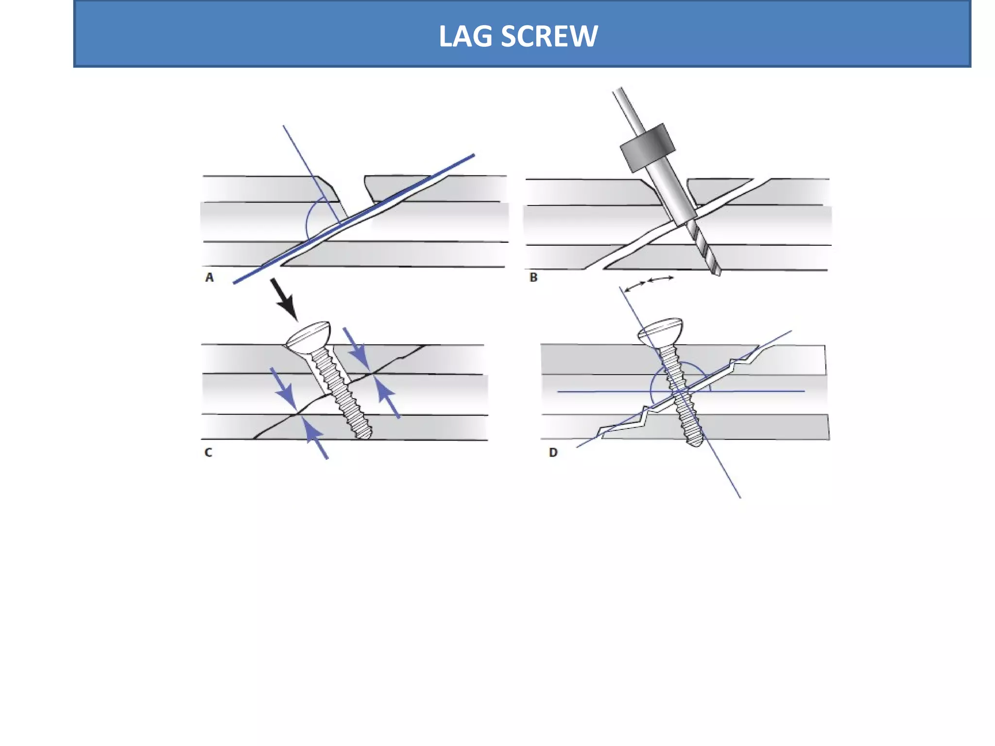 principles of internal fixation | PPT