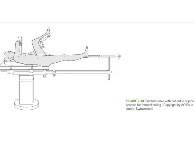 principles of internal fixation | PPT