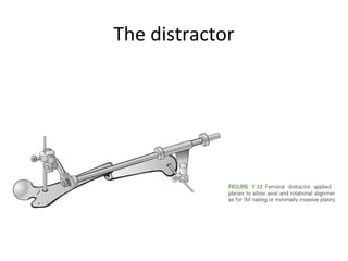 principles of internal fixation | PPT