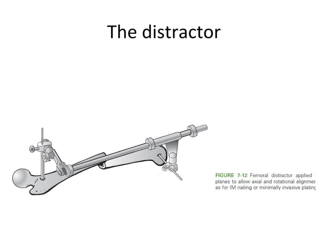 principles of internal fixation | PPT