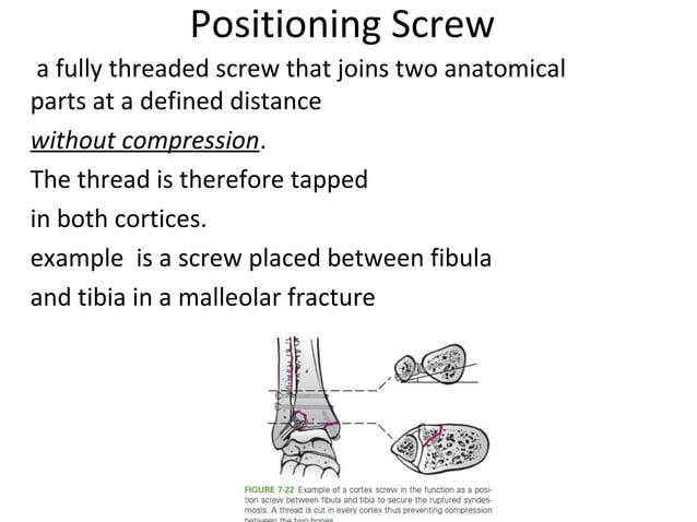principles of internal fixation | PPT