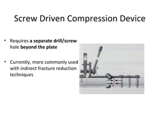 principles of internal fixation | PPT