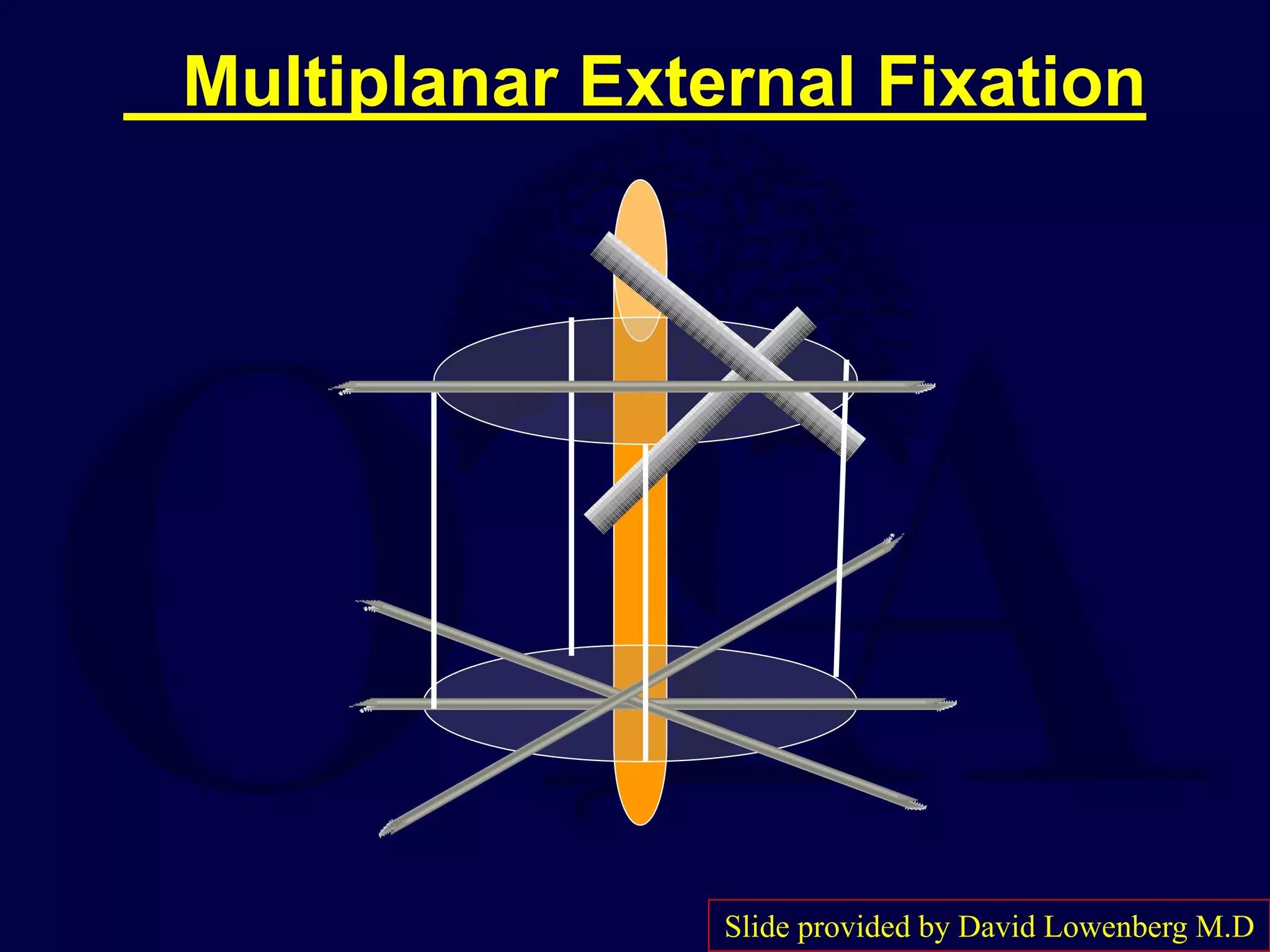 G11-Principles of External Fixation.pdf