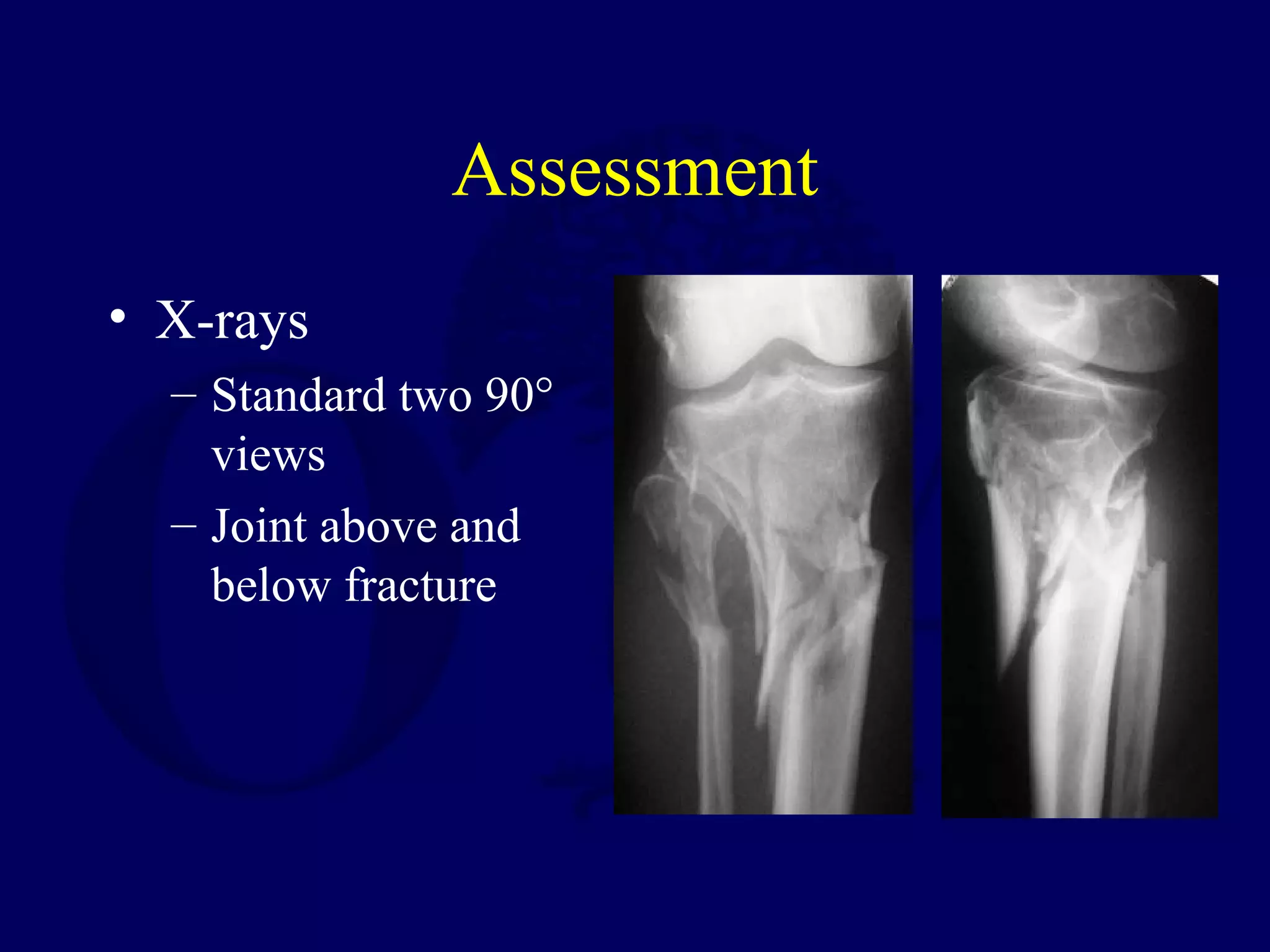 G13 mangled extremity | PPT