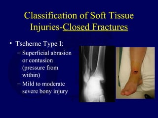 G13 mangled extremity | PPT