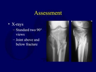 G13 mangled extremity | PPT