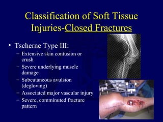 G13 mangled extremity | PPT