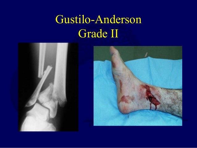 G13 mangled extremity