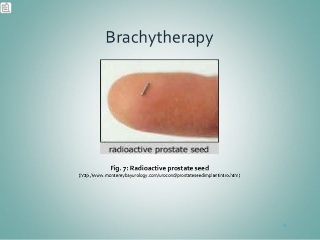 Brachytherapy: Prostate Cancer