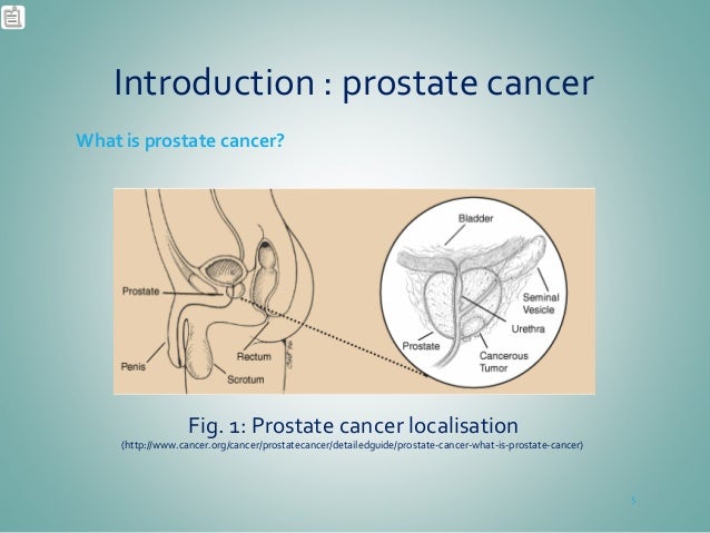 Brachytherapy: Prostate Cancer