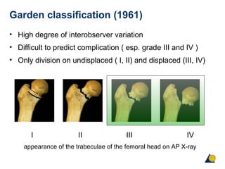 Femoral neck | PPT